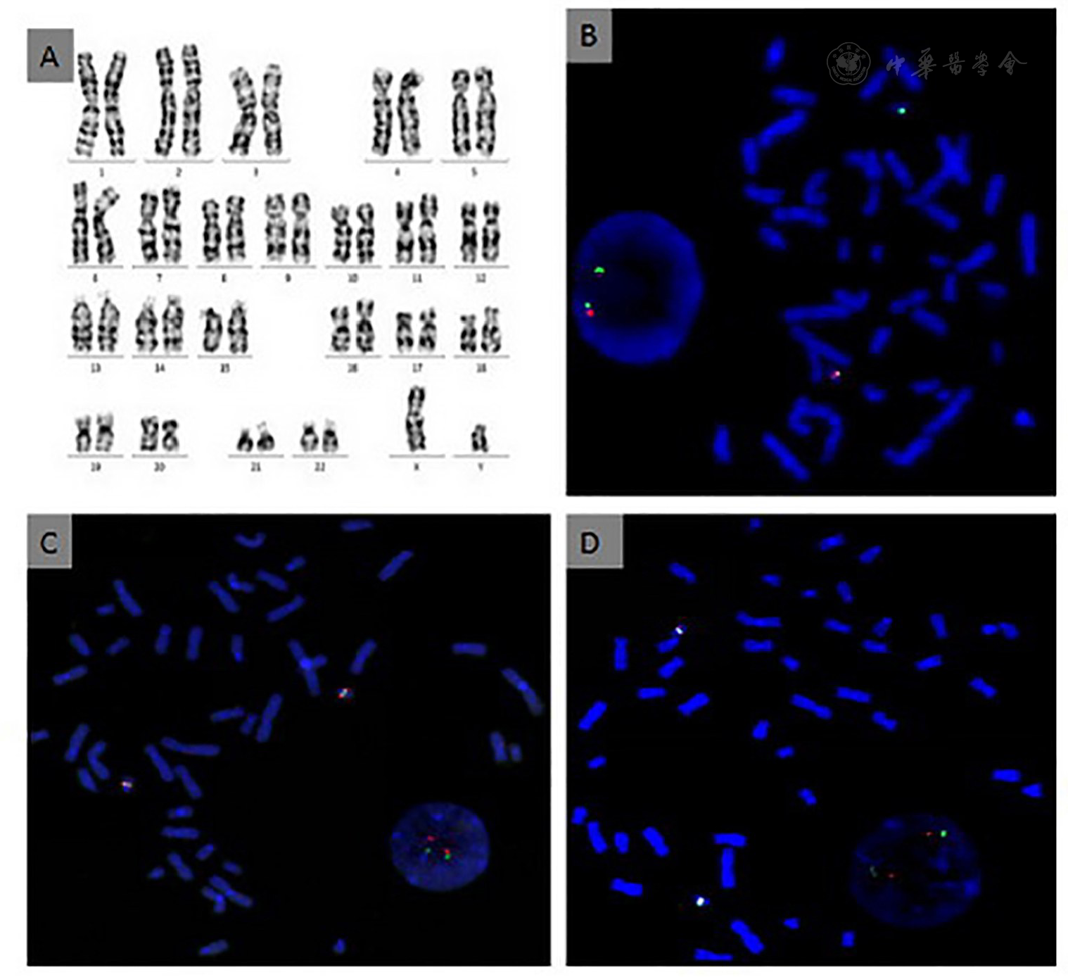 22q11.2经典微缺失所致DiGeorge综合征一例