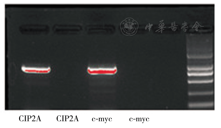 CIP2A及c-myc在结直肠腺癌组织中的表达及其临床意义